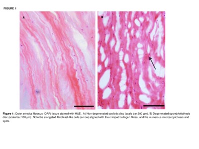 Nerves and blood vessels in degenerated intervertebral discs are ...